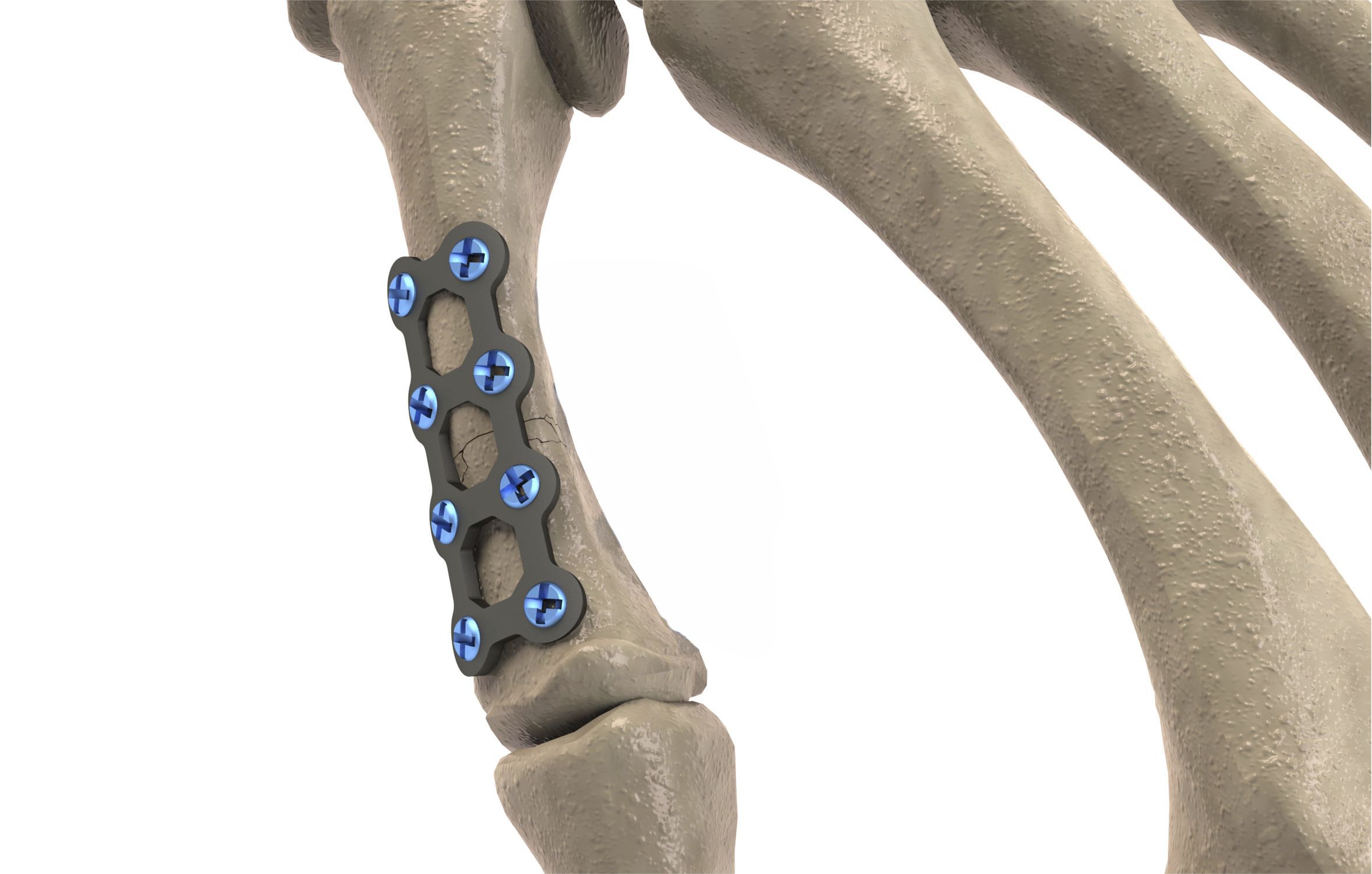 Metacarpal joint compression plate - 1T112-10061506 - Ases Orthopedics ...