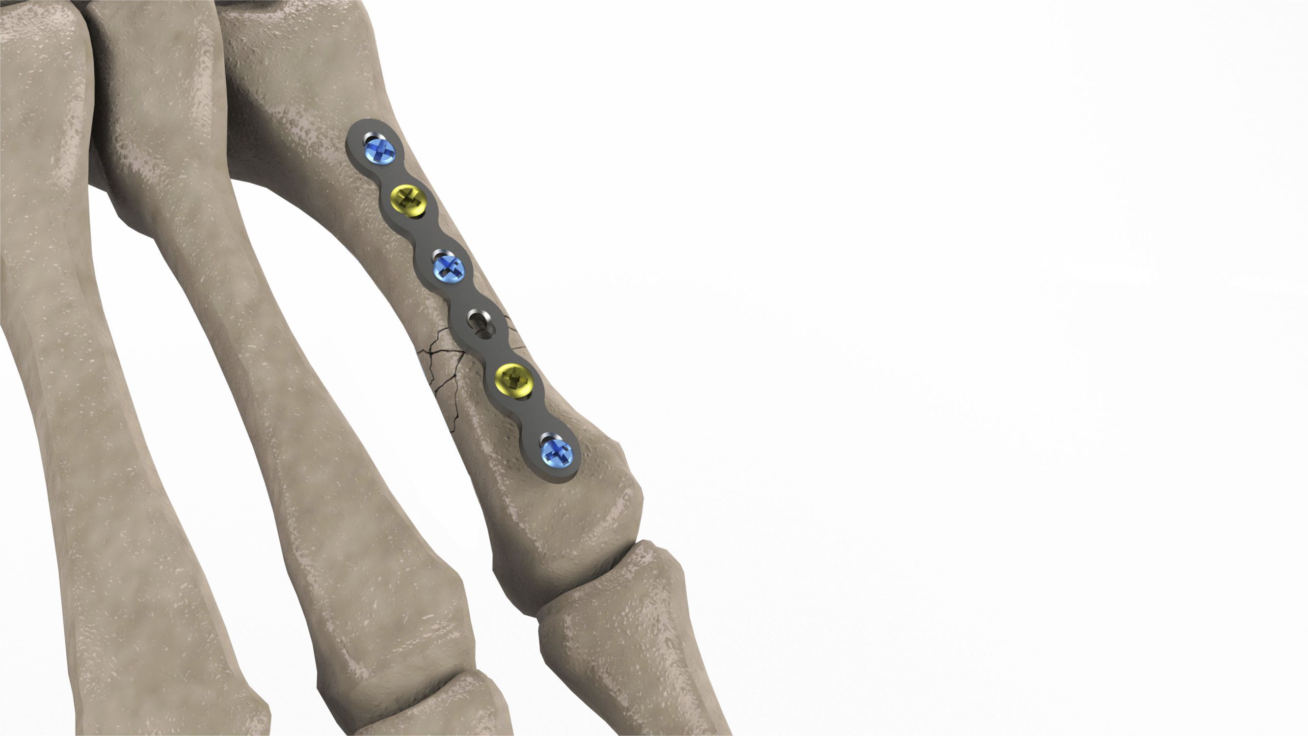 Metacarpal joint compression plate - 1T112-10092006 - Ases Orthopedics ...