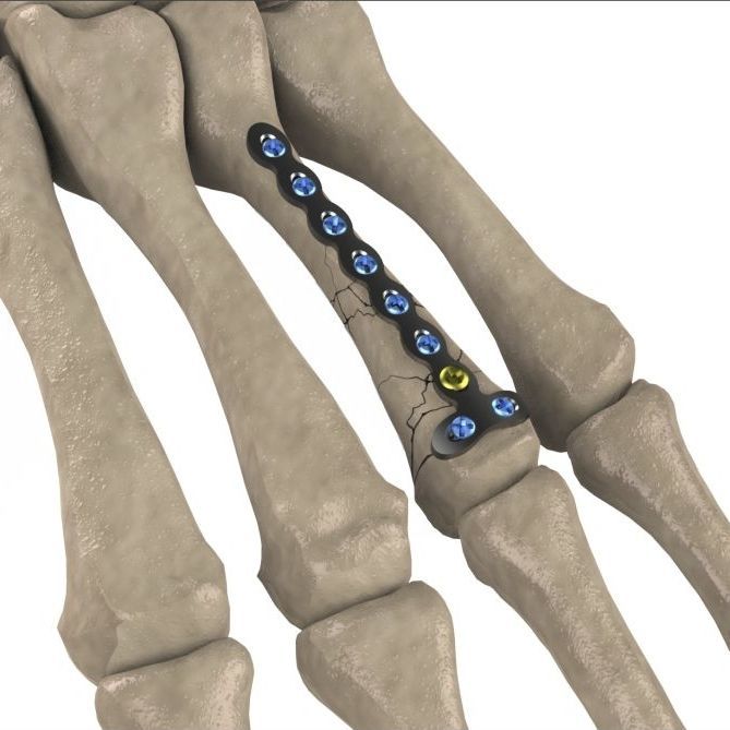 Metacarpal joint compression plate - 1T112-100112023 - Ases Orthopedics ...