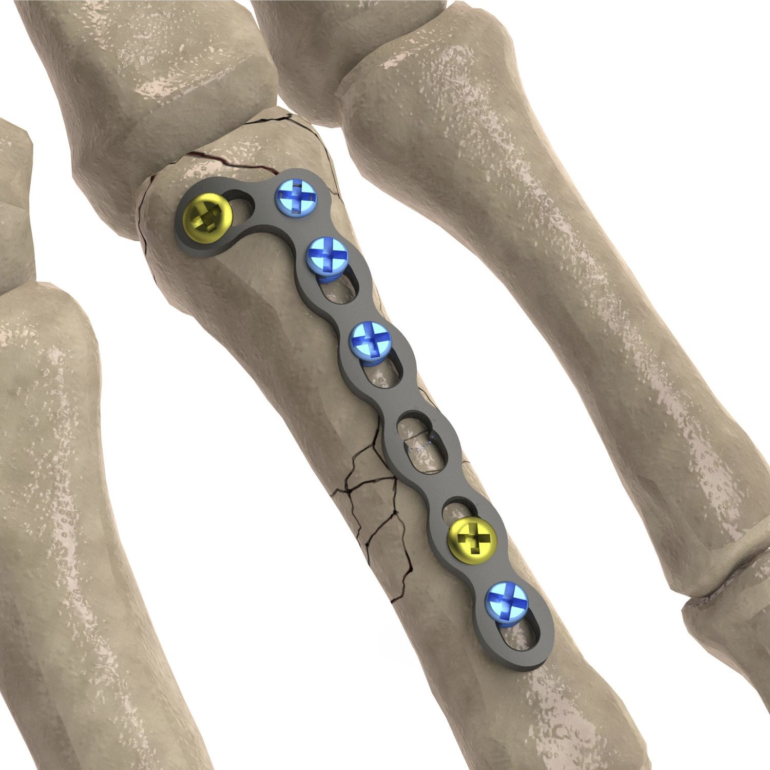 Hand phalange compression plate - LCP Oblique L - Ases Orthopedics ...