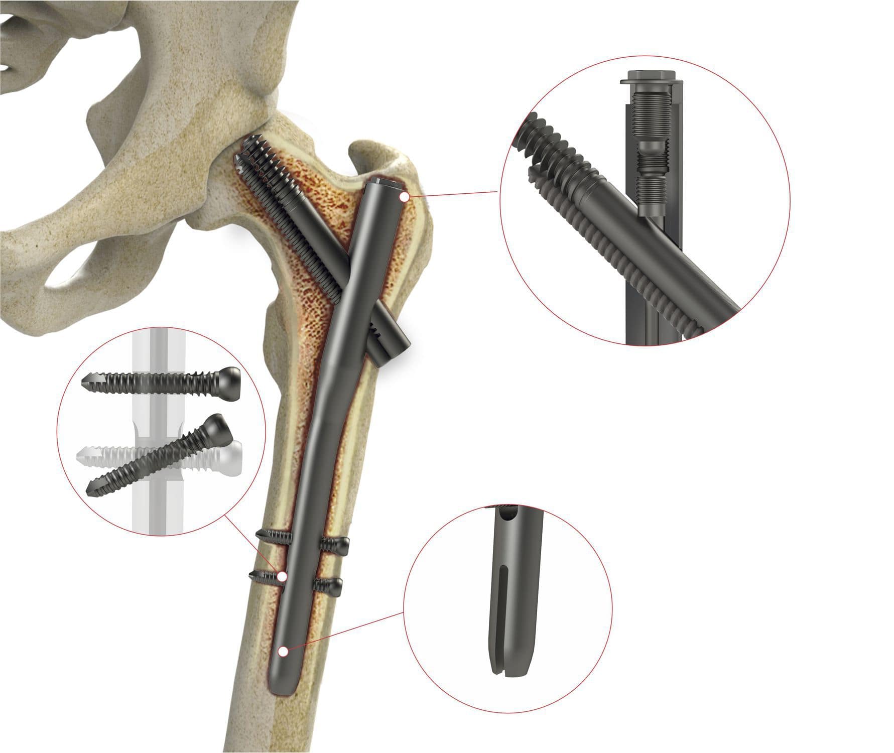 Femoral intramedullary nail - 4T1-40310170 - Ases Orthopedics ...