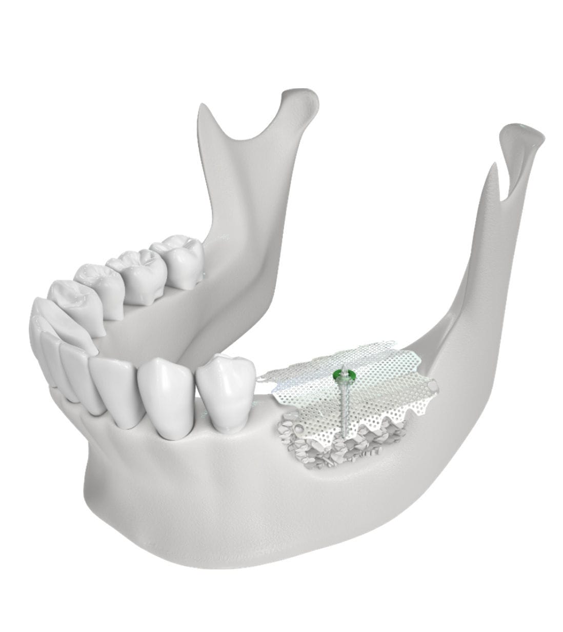Titanium dental material - CTi-mem - Neobiotech - for dental restorations