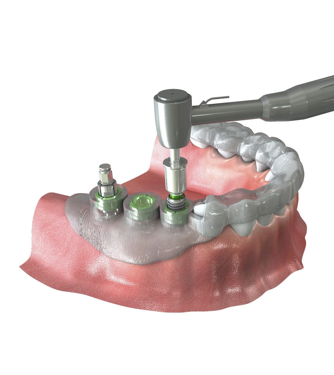 Dental surgery surgical navigation system - Neo NaviGuide - Neobiotech ...