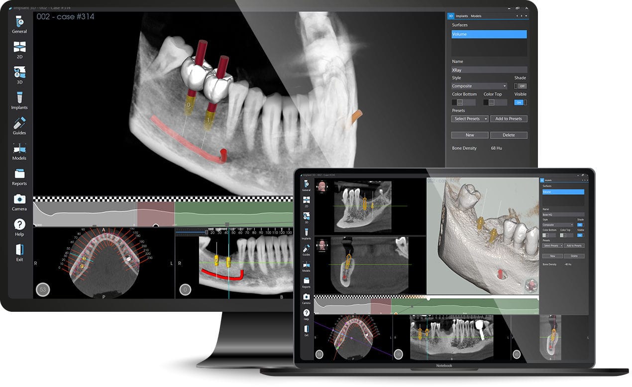 Design software - Implant 3D - MediaLab - 3D simulation / inspection ...