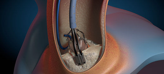 Atherectomy catheter - GEMINI - Aorticlab - aortic