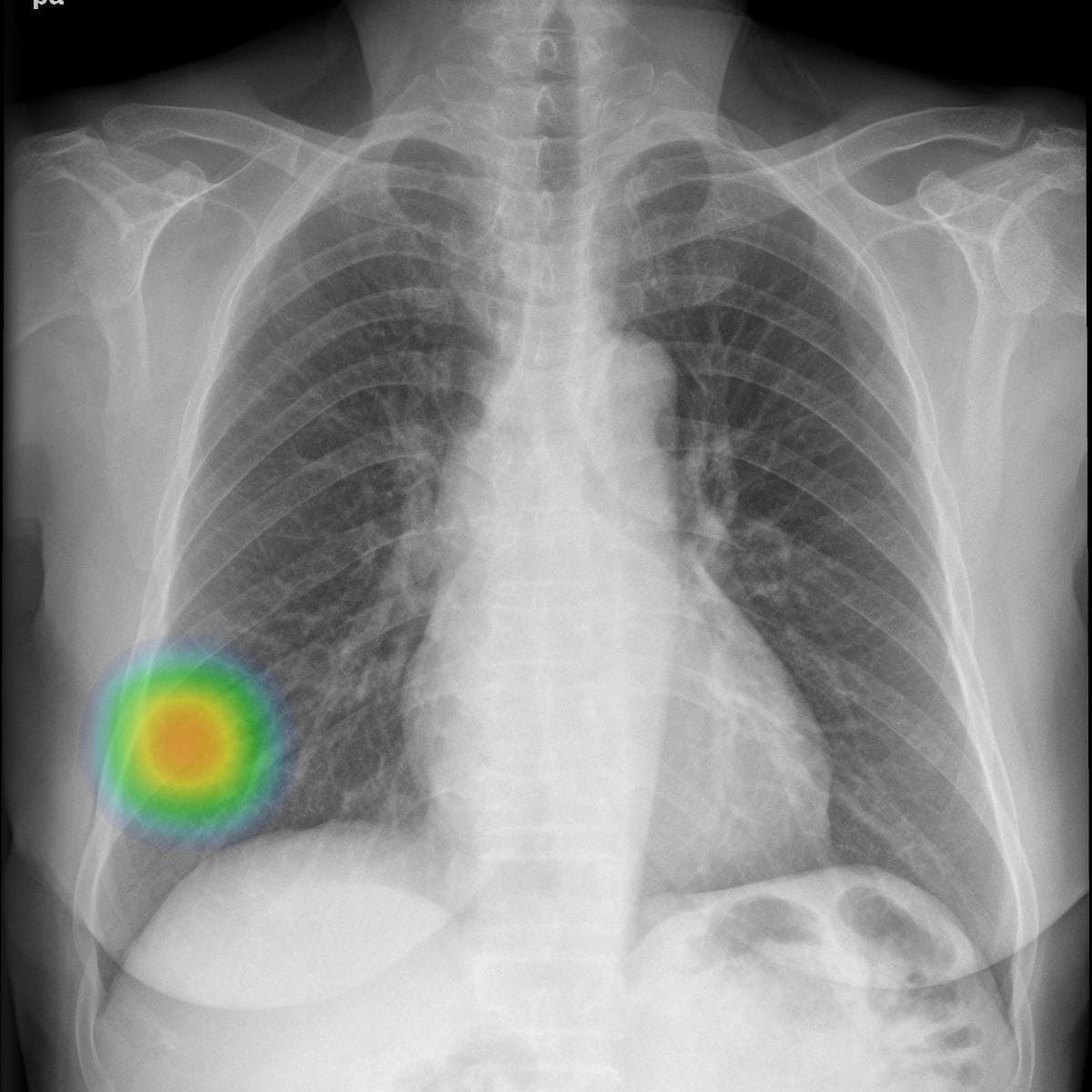 X-ray imaging software - INSIGHT CXR - Lunit - screening / medical / lung