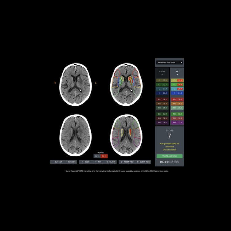 Stroke diagnosis software - ASPECTS - RapidAI - scan / evaluation ...
