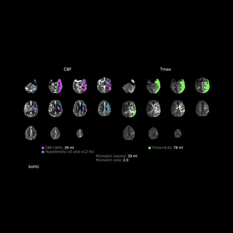 Analysis software - CTP - RapidAI - scan / aid / medical