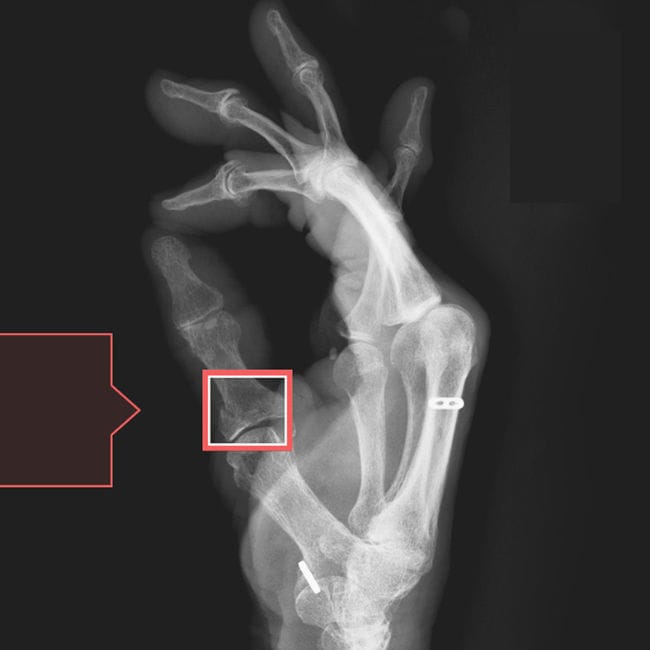 Fracture detection software - RBfracture™ - Radiobotics - analysis ...