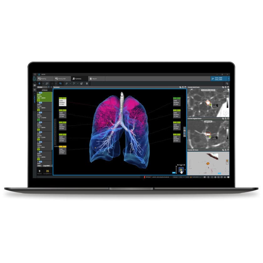 Lung cancer screening software - LCS - Coreline - image analysis ...