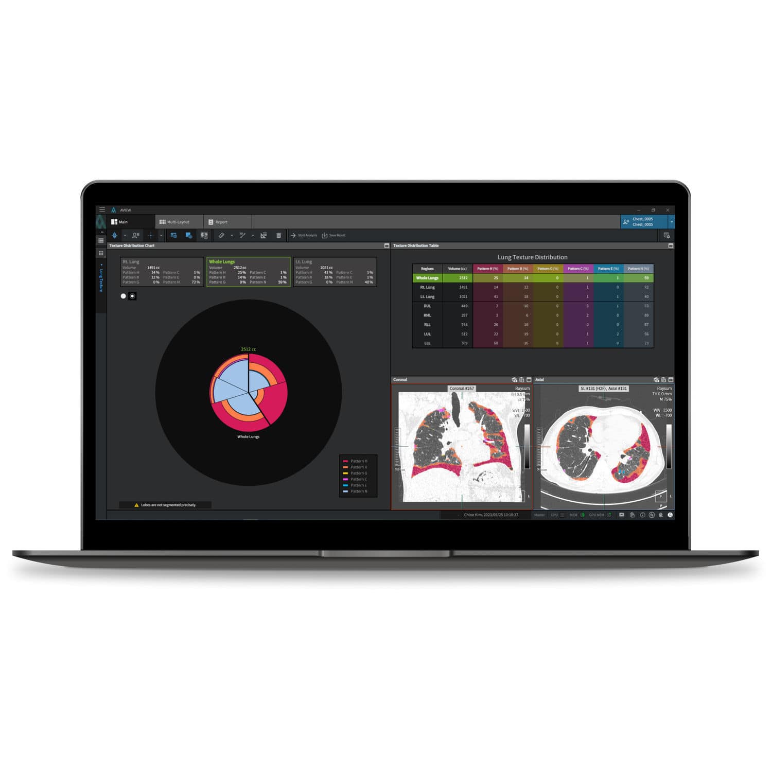 Analysis software - Coreline - reporting / interpretation / medical
