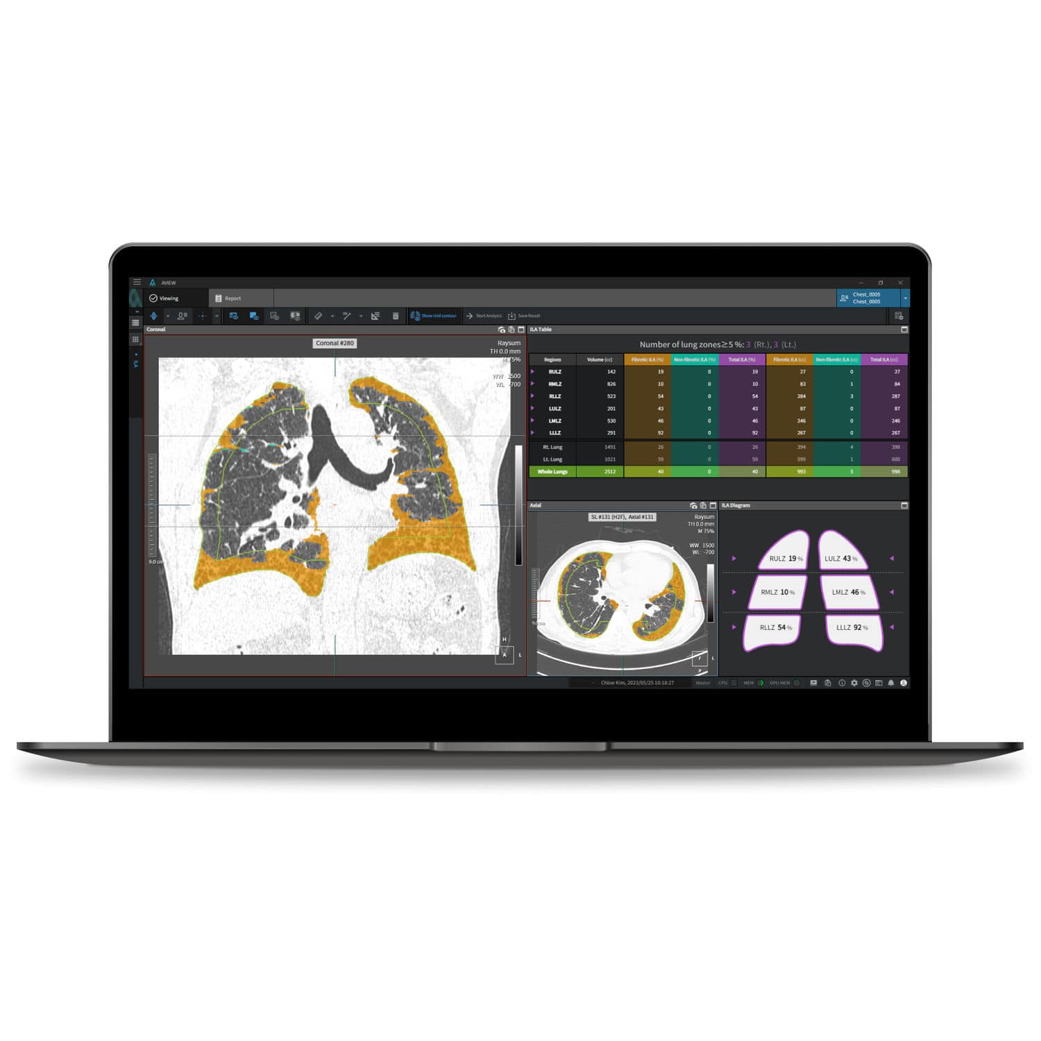 Analysis software - ILA - Coreline - reporting / medical / lung