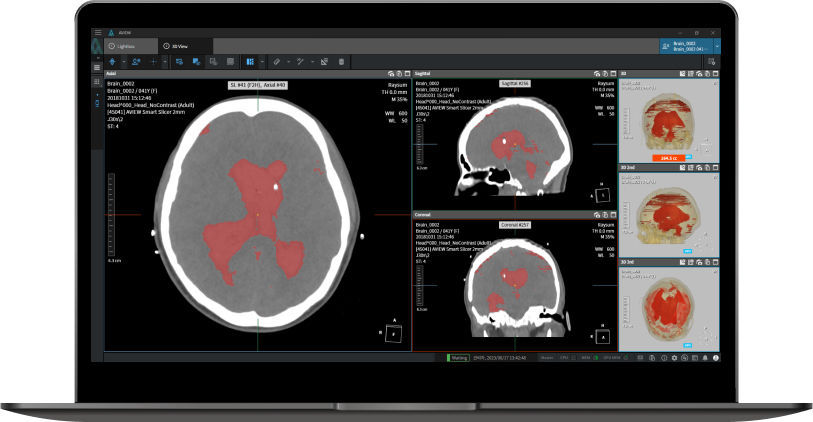 Analysis software - NeuroCAD - Coreline - viewer / diagnostic / treatment