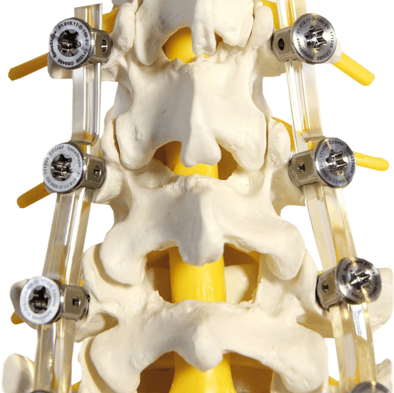 Lumbar osteosynthesis unit - SpineShape System IV - SpineSave ...