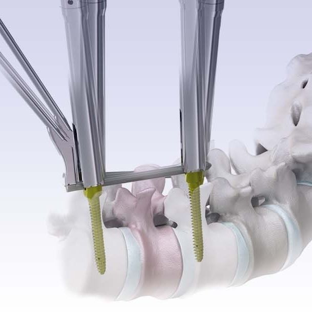 Minimally invasive pedicle screw positioning system - VENUS®mini 2.0 ...