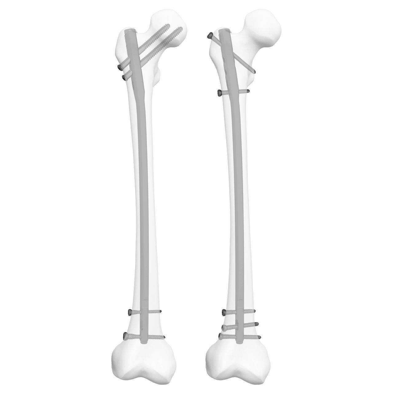 Femoral intramedullary nail - 305009 - Boneunion Medical - proximal ...