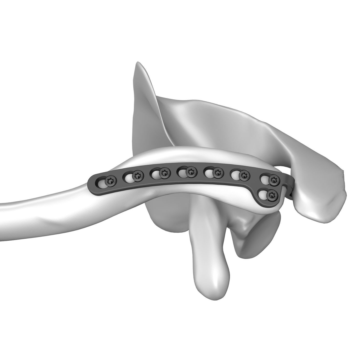 Clavicle compression plate - 301006 series - Boneunion Medical - distal ...