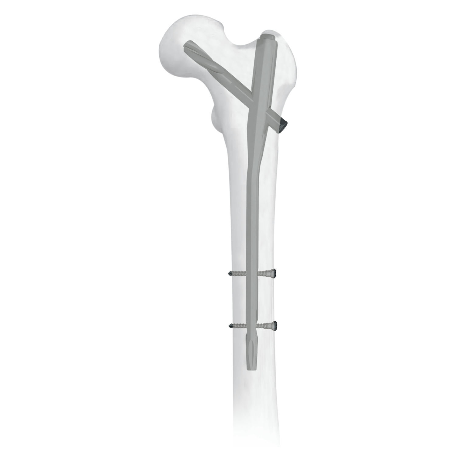 Femoral intramedullary nail - 30500 series - Boneunion Medical ...