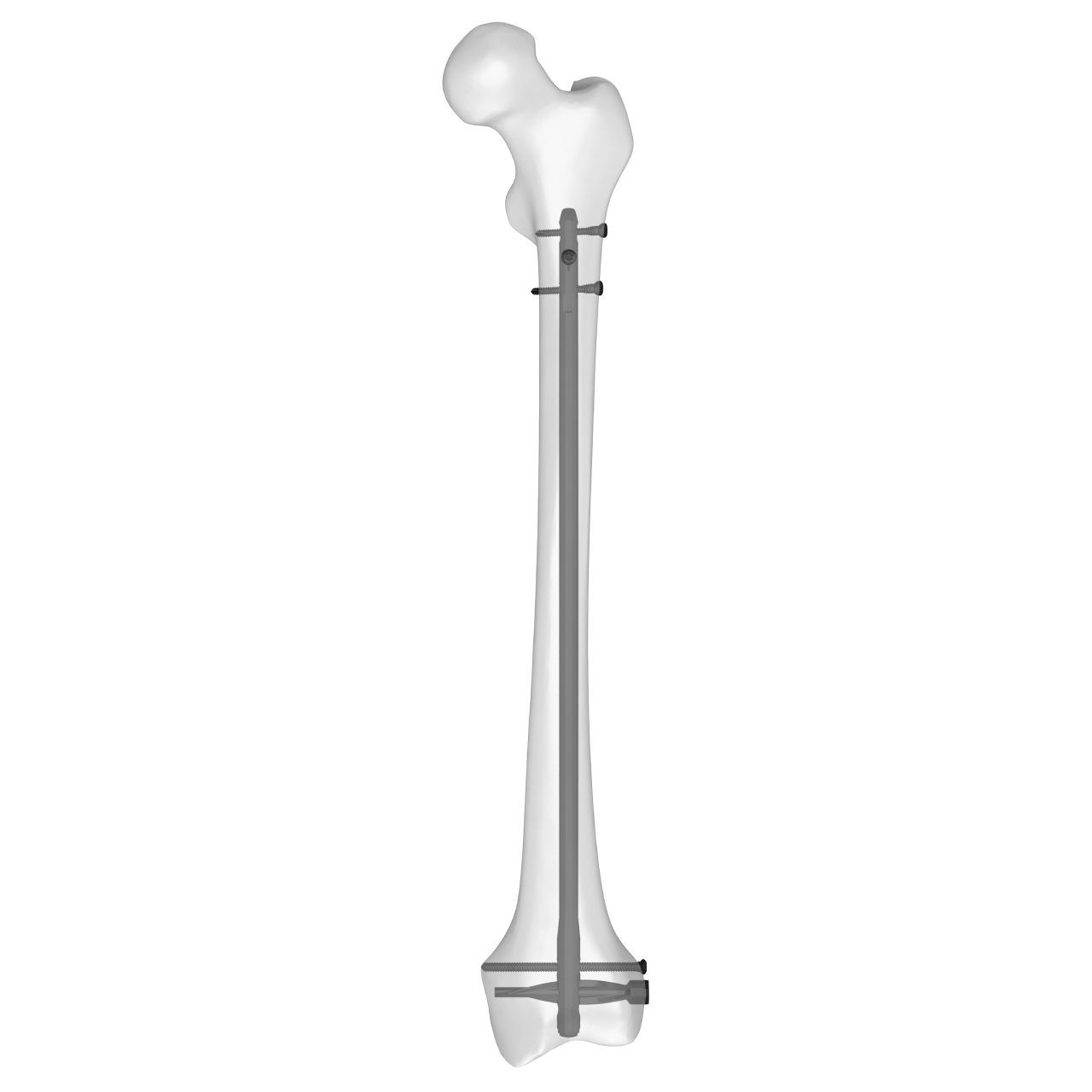 Femoral intramedullary nail - 30510 series - Boneunion Medical - distal ...