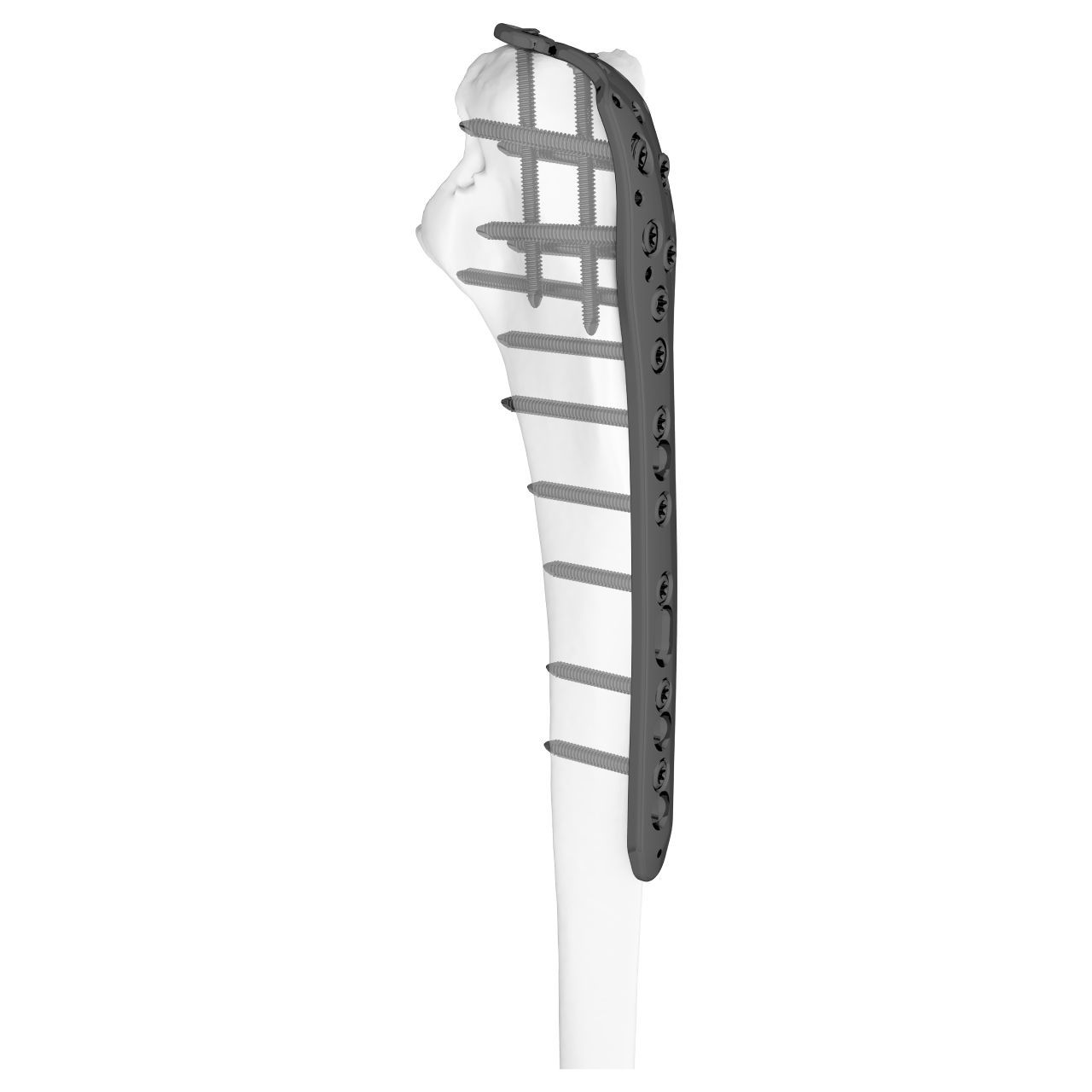 Olecranon compression plate - 301043 series - Boneunion Medical - ulna ...