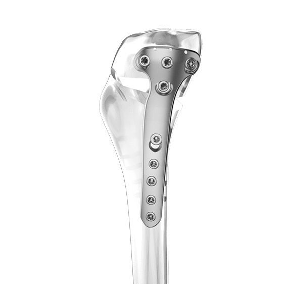 Tibia osteotomy plate - Aplus Biotechnology - proximal / locking / titanium