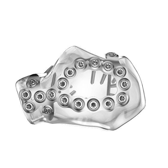 Calcaneus compression plate - TOPUS - Aplus Biotechnology - locking ...