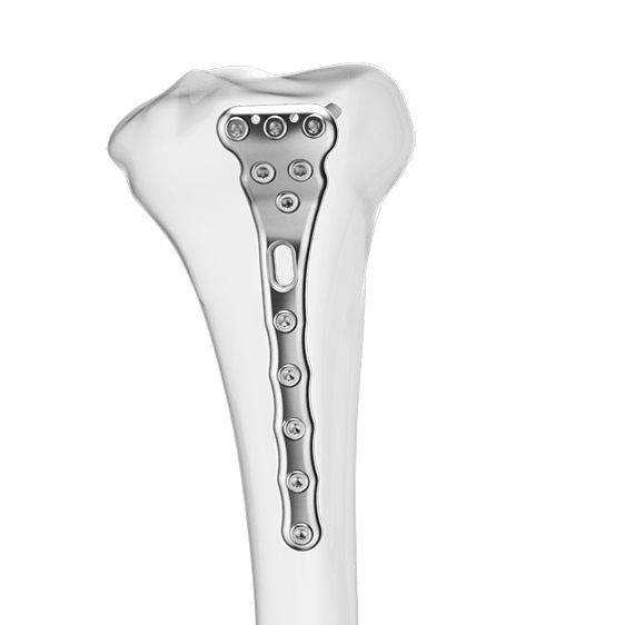 Tibia compression plate - Aplus Biotechnology - proximal ...