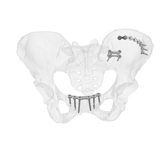 Pelvis compression plate - 1515-0200-01 - Aplus Biotechnology - locking ...