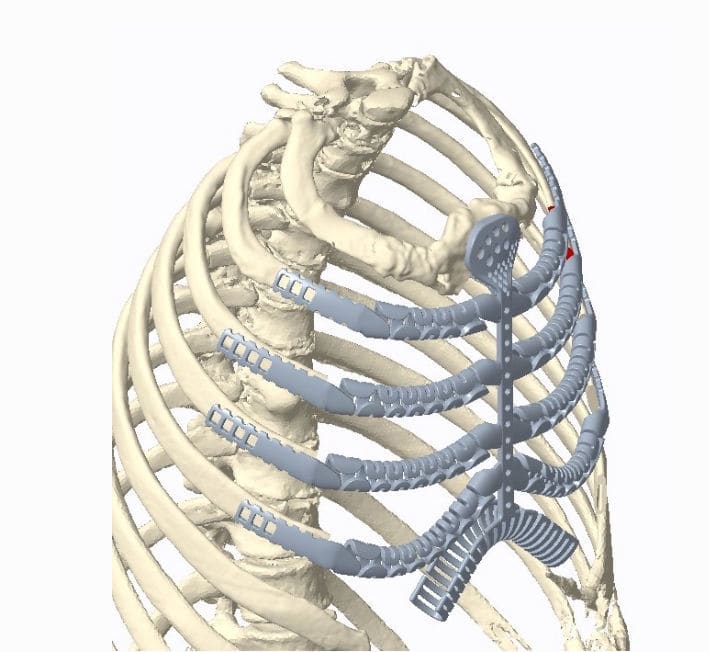 Osteosarcoma resection reconstruction rib prosthesis - Osteobionix