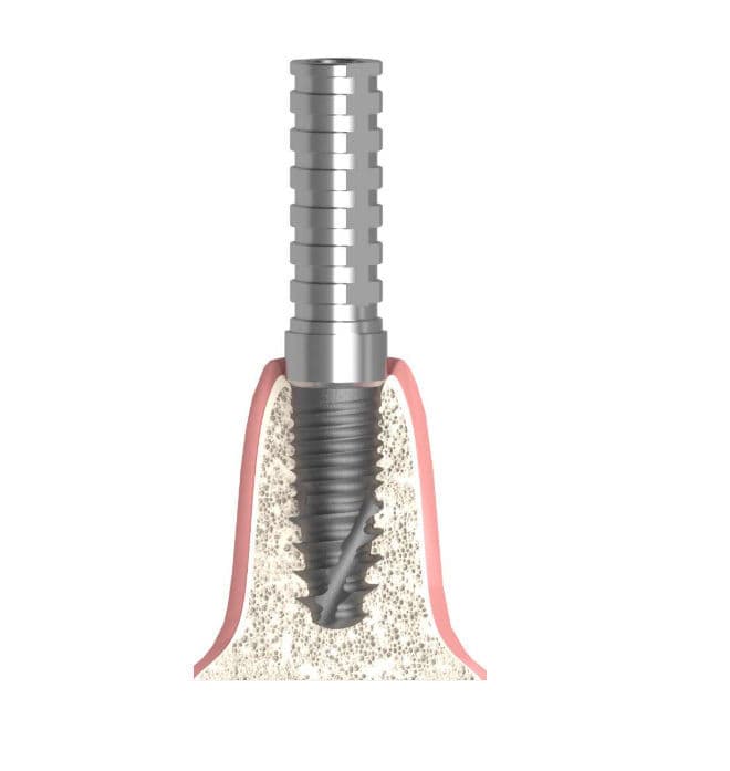 Cylindro-conical implant abutment - Actival - Bionika Medline Kft ...