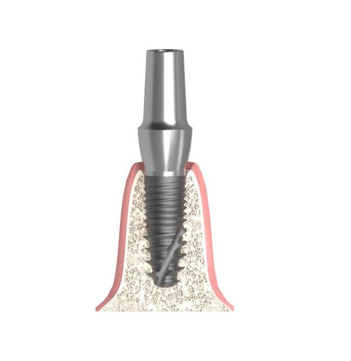 Cylindro-conical implant abutment - Actival - Bionika Medline Kft ...