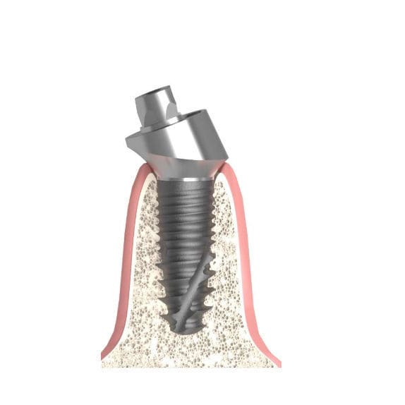 Cylindro-conical implant abutment - 517.894.300.010 - Bionika Medline ...