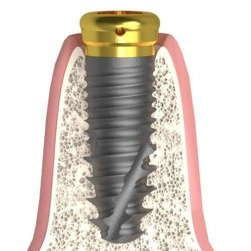 Locator® implant abutment - BIOPLANT - Bionika Medline Kft. - cylindro ...