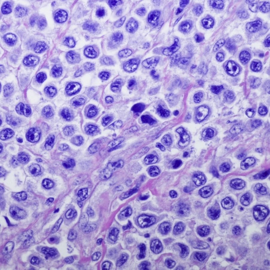 Lymphoma test kit - Lymph™ - Geneseeq - oncology / for precision ...