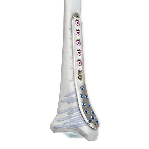 Tibia compression plate - LOQTEQ® 3.5 - aap Implantate - distal ...