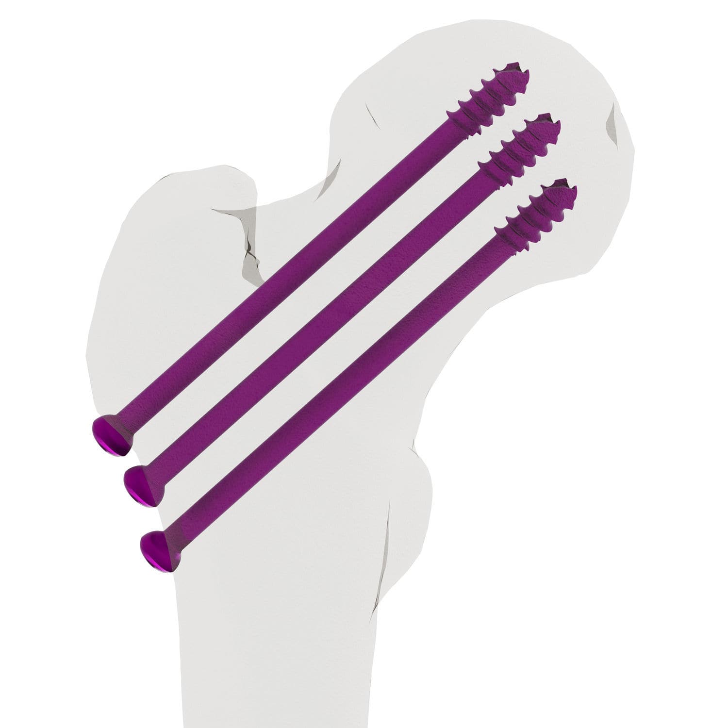 Wrist compression bone screw - 15-02800 - AF Medical - tibia / femur ...