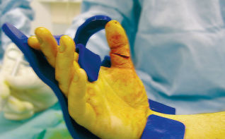 Orthopedic surgery hand support - KIROFIX Large - AKED