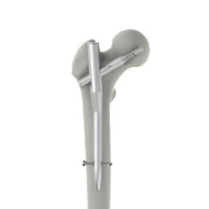 Femoral intramedullary nail - INTERNA® PFN - BAUMER - proximal fixation ...