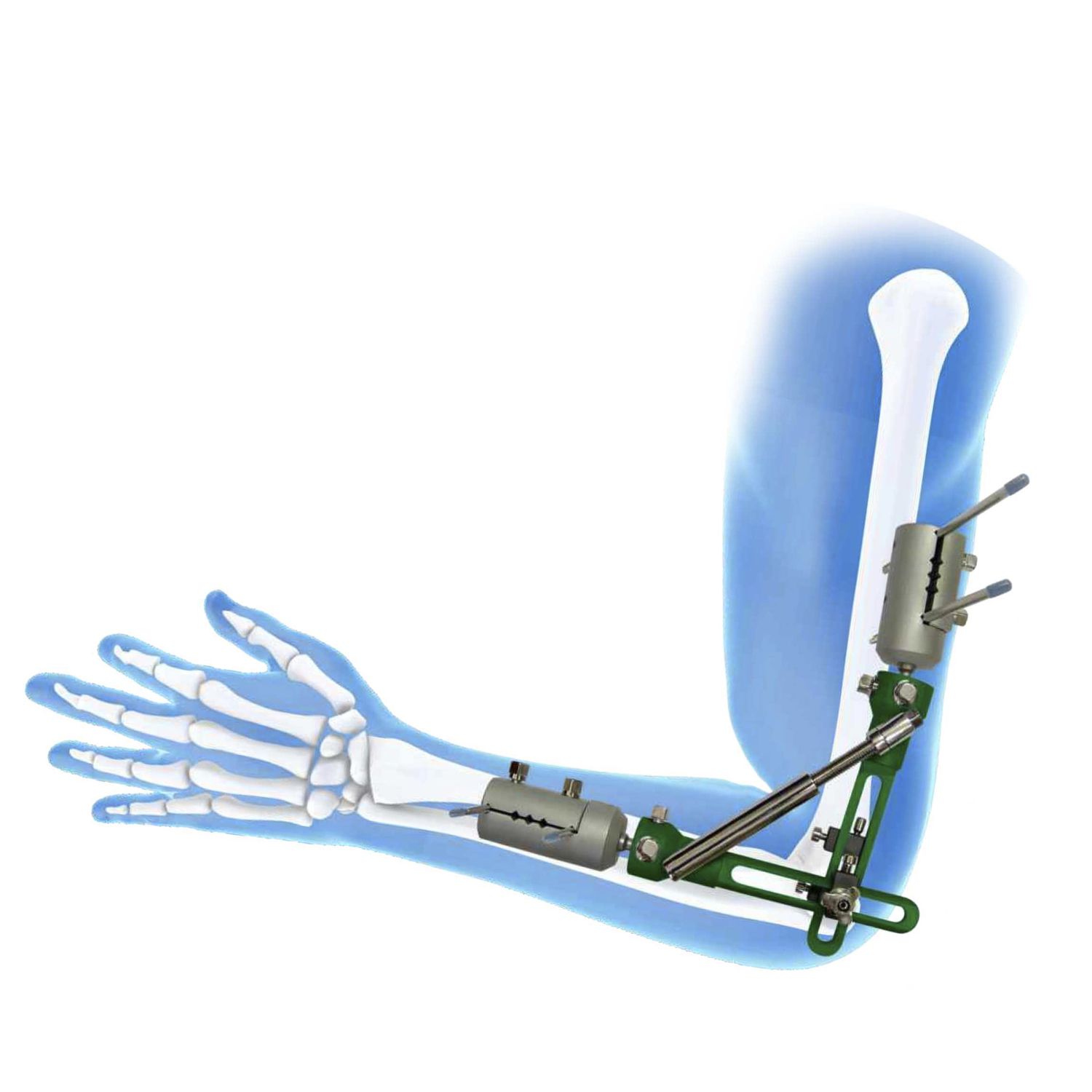 Elbow external fixation system - 566 - BAUMER - tubular / adult