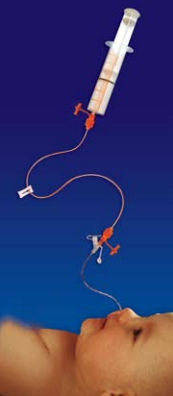 Enteral feeding set - CORFLO® ANTI-IV - CORPAK MedSystems
