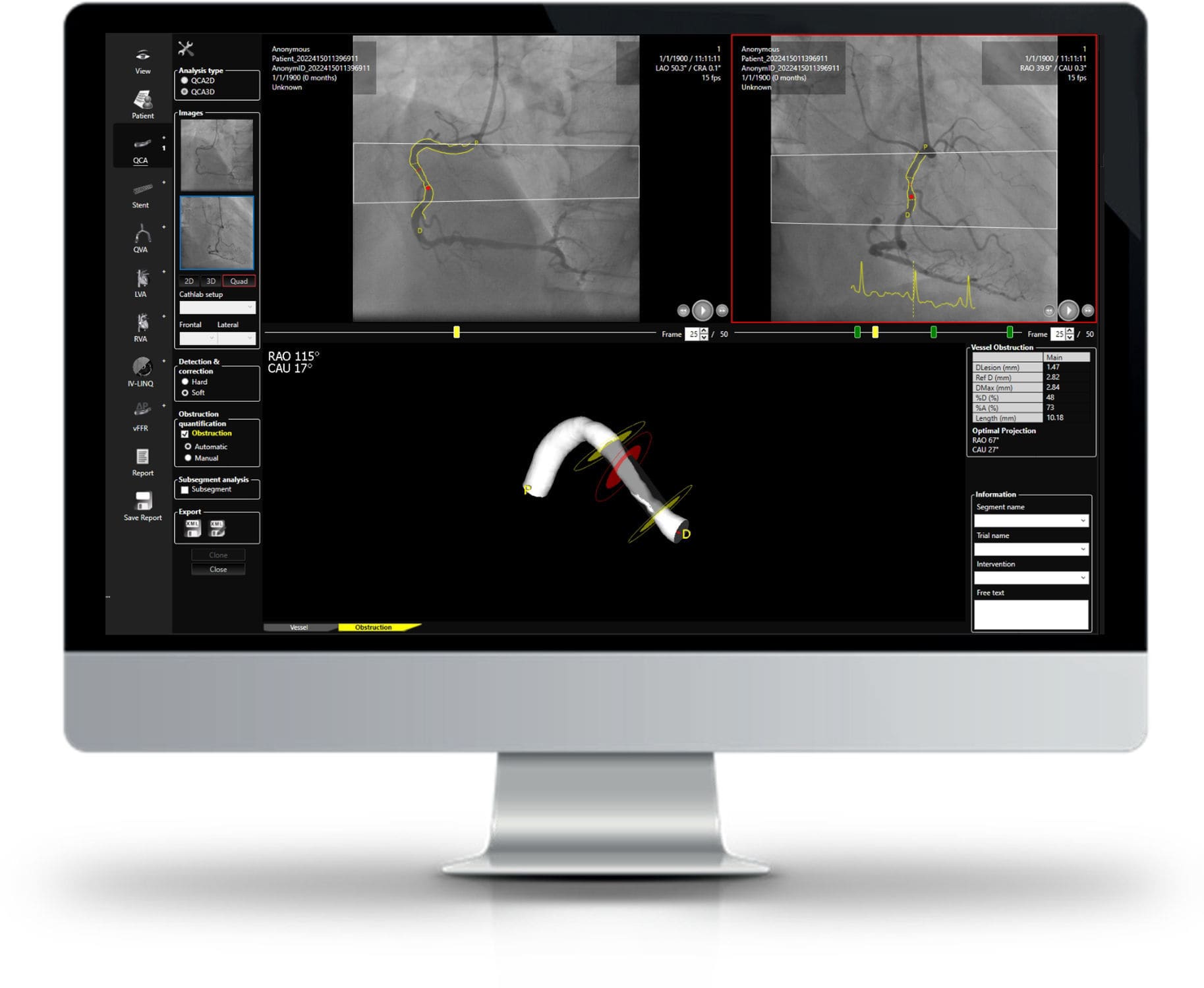 Analysis software - CAAS WORKSTATION - Esaote - visualization / angiography