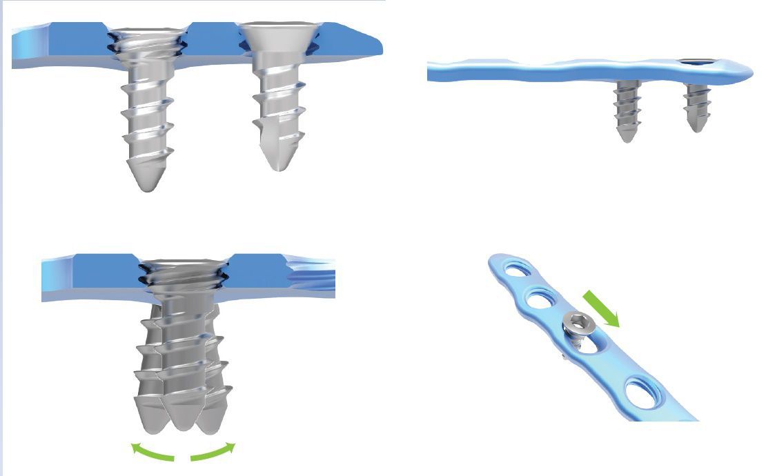 Foot osteotomy plate - ARIX - Jeil Medical Corporation