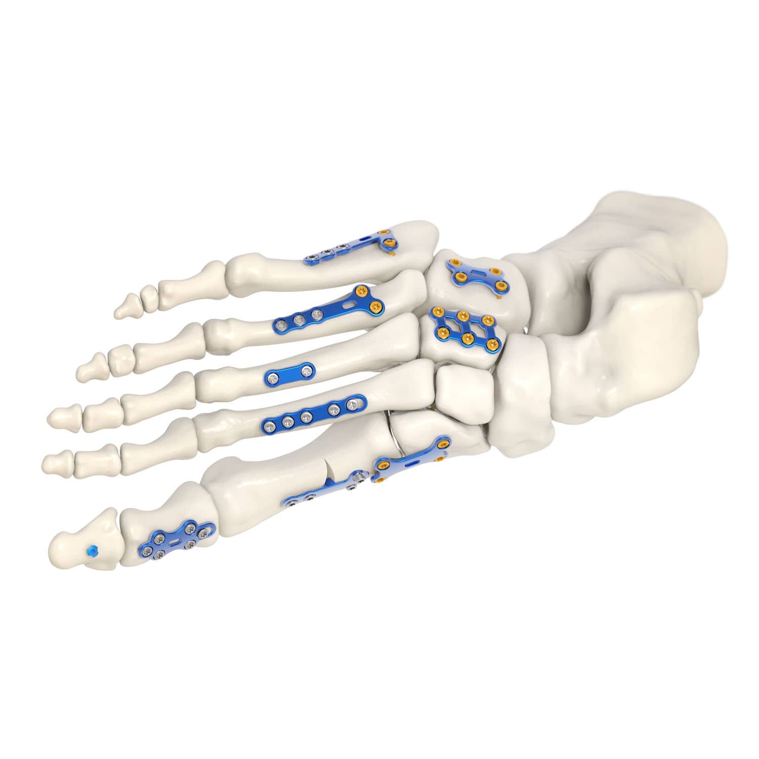 Forefoot compression plate - Jeil Medical Corporation - locking / titanium