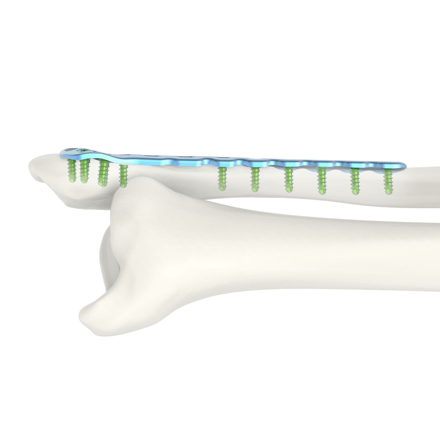 Fibula compression plate - ARIX - Jeil Medical Corporation - distal ...