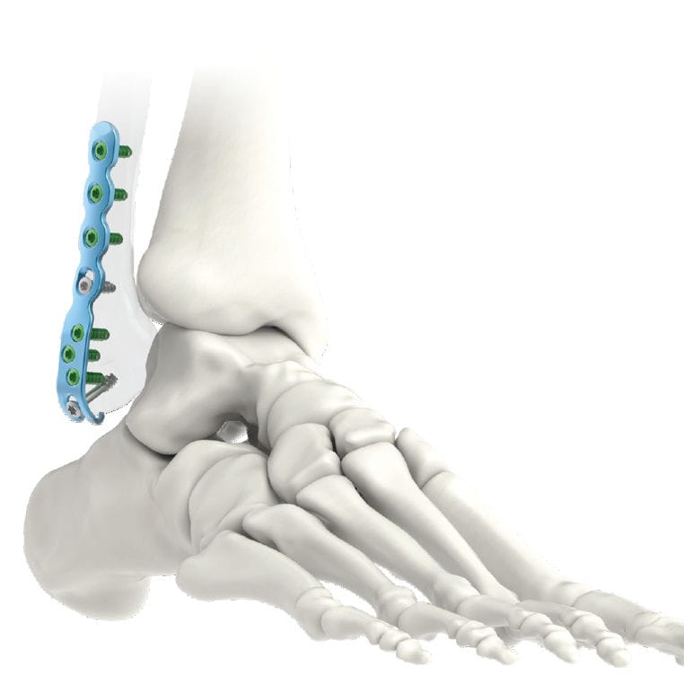 Fibula compression plate - ARIX 3.5 - Jeil Medical Corporation - distal ...