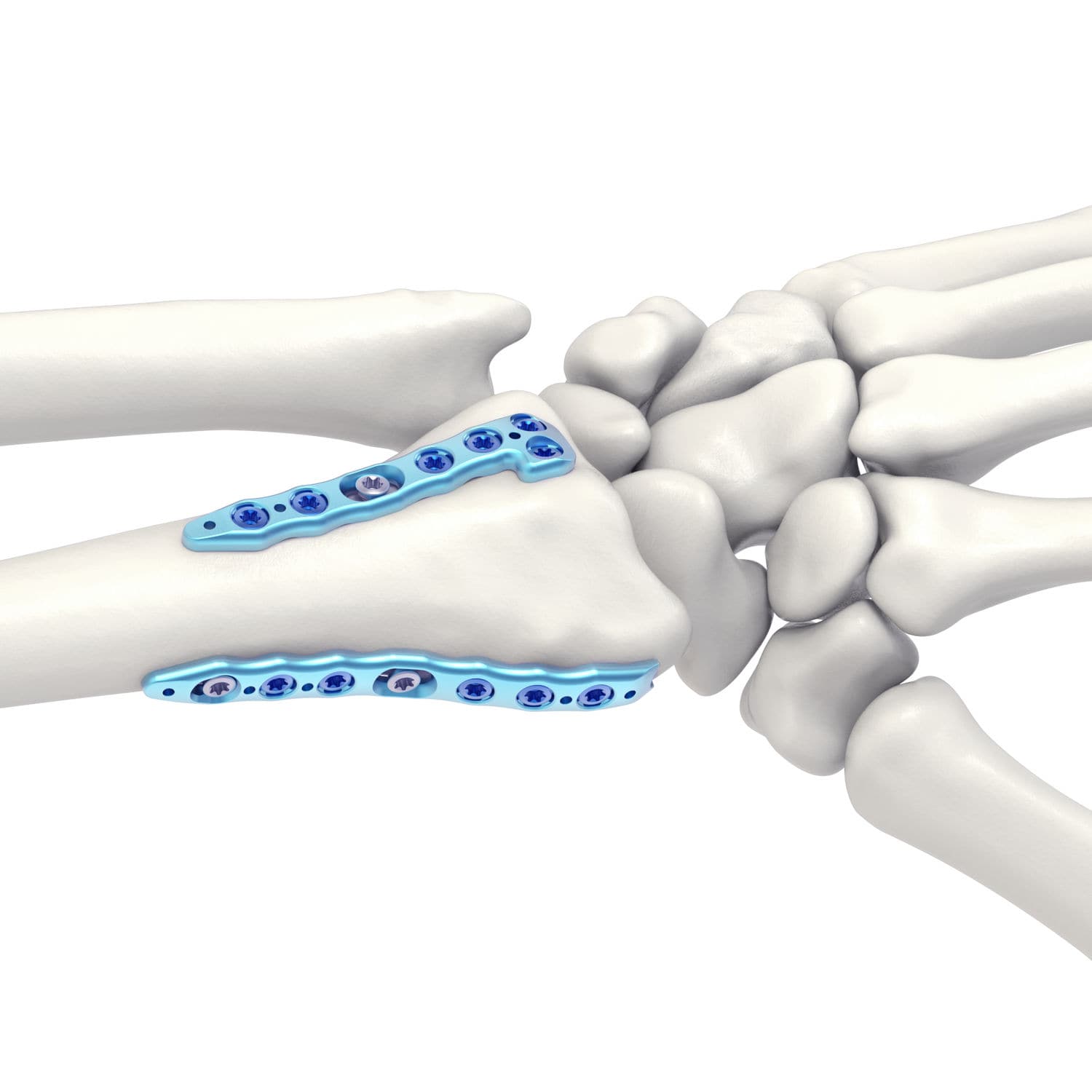 Radius compression plate - ARIX 2.5 - Jeil Medical Corporation - distal ...