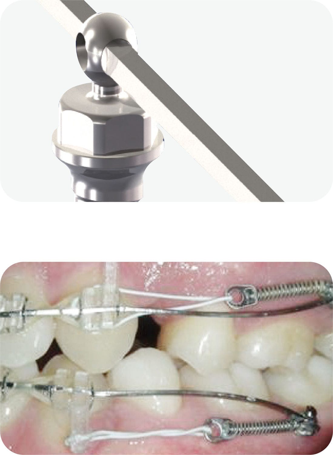 Screw dental mini-implant - DualTop - JO Type - Jeil Medical ...