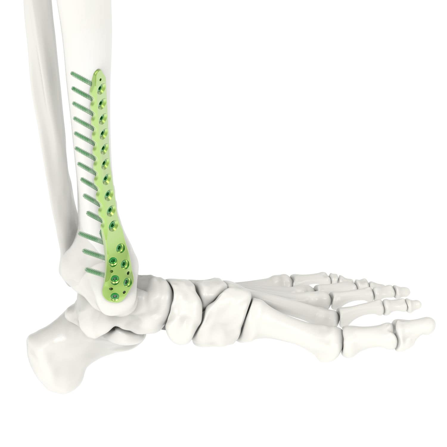 Tibia compression plate - ARIX 3.5/4.0 - Jeil Medical Corporation ...