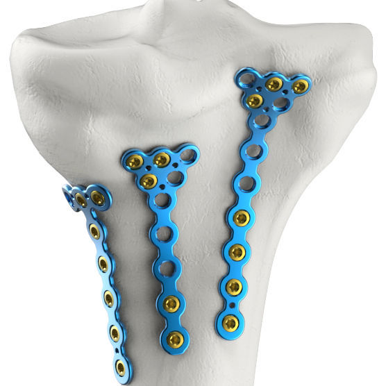Small bone fragment compression plate - Jeil Medical Corporation ...