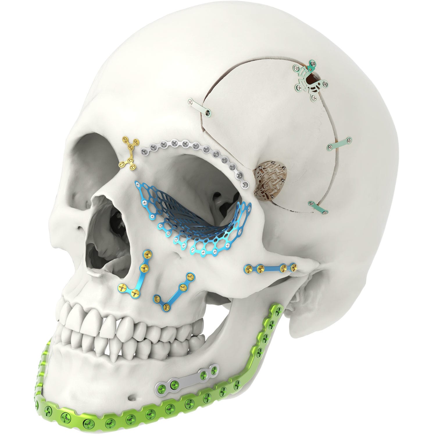 Skull compression plate - ARIX 3.5/4.0 - Jeil Medical Corporation ...